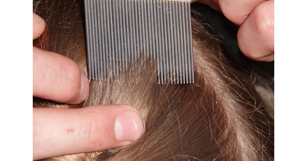 Guida completa: Come riconoscere i pidocchi - Segni e sintomi ...