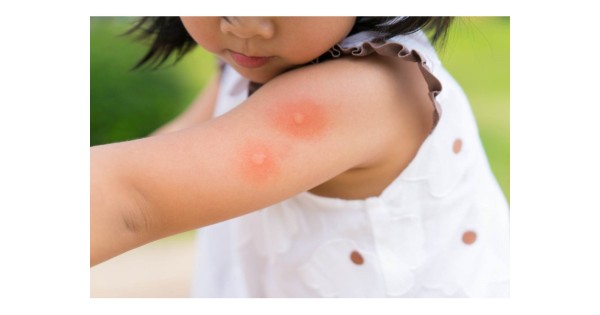 Perché le zanzare pungono proprio me?! |FarmaciaGaudiana.it